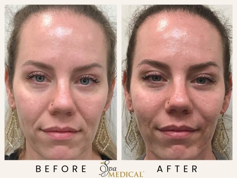 Weight Loss and Facial Volume Loss: What You Need to Know | Spa Medical