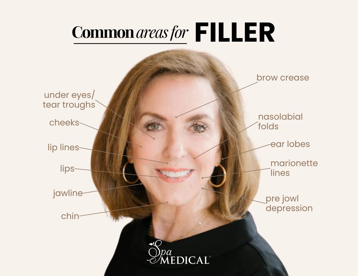 JUVÉDERM® - Dermal Fillers Macon GA
